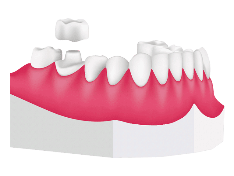 Toddler & Children's Dental Crowns, London | Toothbeary Dental