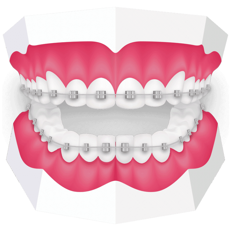 Teenagers fixed orthodontics - Toothbeary