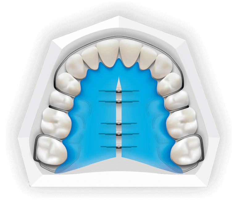 Removable kids braces | Richmond, London, TW1 | Children's Orthodontist
